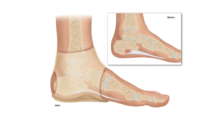 What are Heel Spurs? Learn Symptoms, Causes, and Treatment
