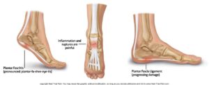 Plantar Fascial Thickening: Prevention and Treatment | Heel That Pain