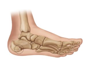 What are Heel Spurs? Learn Symptoms, Causes, and Treatment