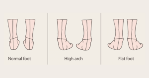 Learn Your Foot Arch Type With The Wet Test | Heel That Pain