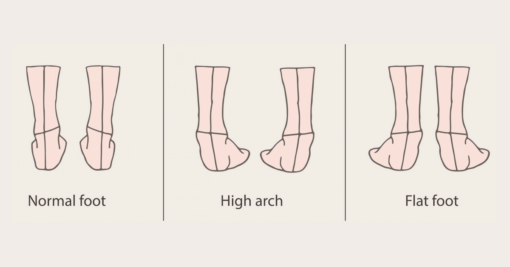 Learn Your Foot Arch Type With The Wet Test | Heel That Pain