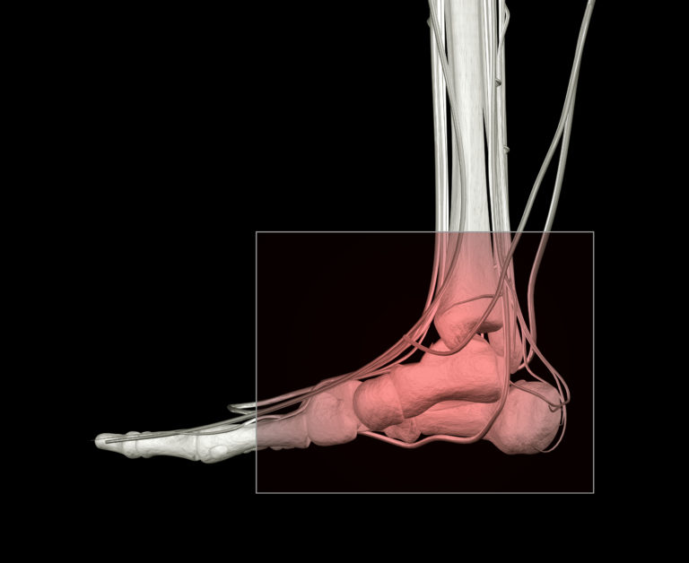 Could Your Heel Pain Be Bursitis? | Heel That Pain